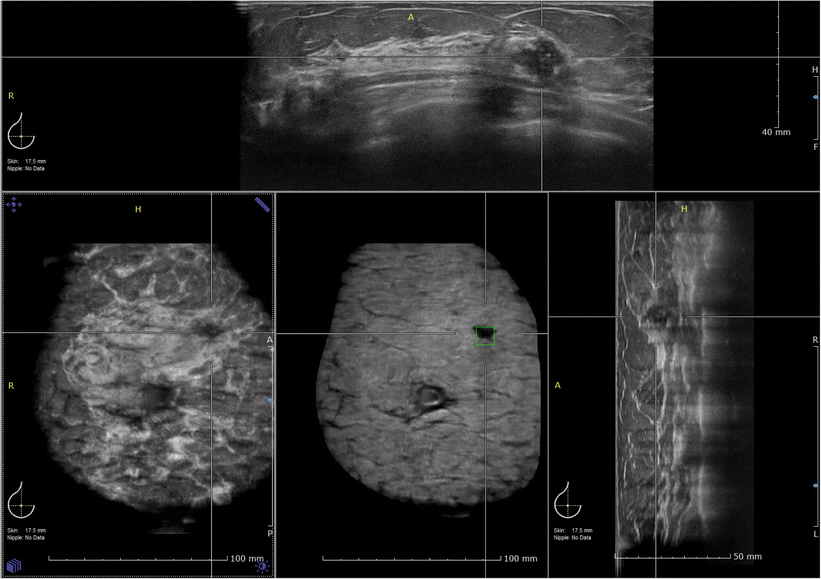 Dedicated computer-aided detection software for automated 3D breast ...