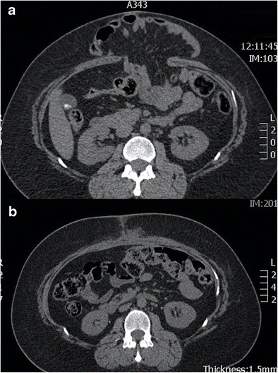 Imaging complex ventral hernias, their surgical repair, and their ...