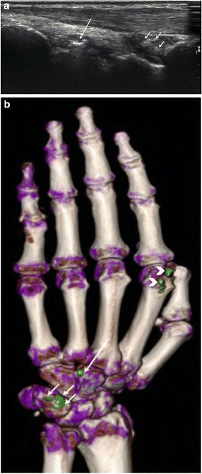 Gout of hand and wrist: the value of US as compared with DECT ...