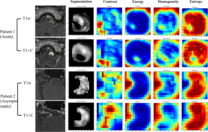 Identification of high-risk plaque features in intracranial ...