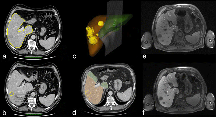 Post-hepatectomy liver failure after major hepatic surgery: not only ...