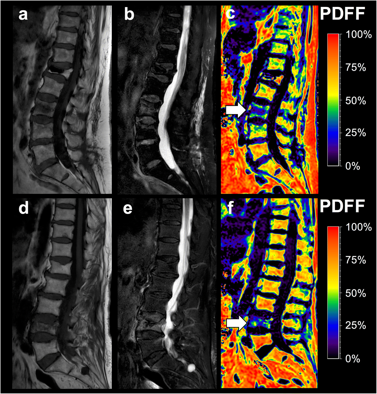 Proton density fat fraction (PDFF) MR imaging for differentiation of ...