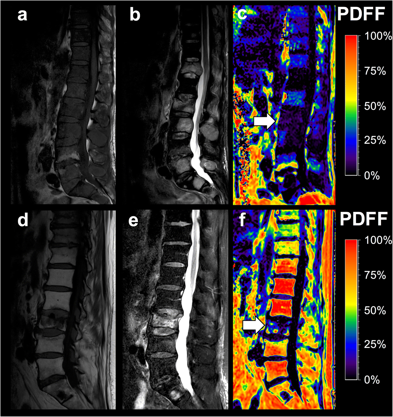 Proton density fat fraction (PDFF) MR imaging for differentiation of ...