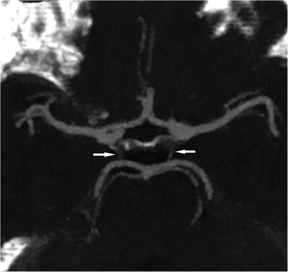 Multidetector CT angiography of the Circle of Willis: association of ...