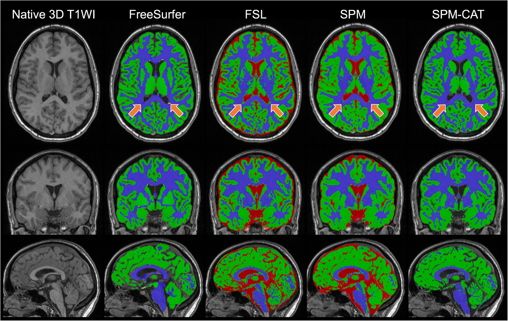 Repeatability and reproducibility of FreeSurfer, FSL-SIENAX and SPM ...