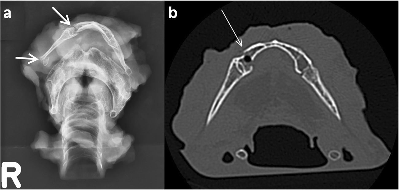The value of post-mortem computed tomography of burned victims in a ...