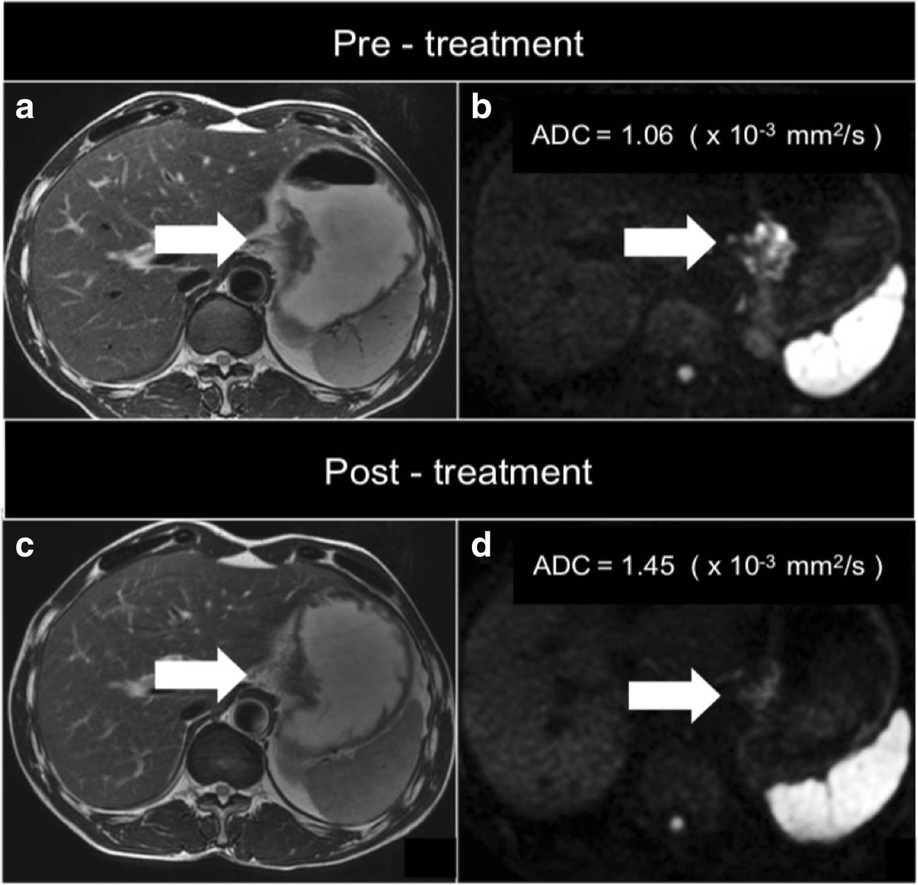 Gastric cancer and imaging biomarkers: Part 1 – a critical review of DW ...