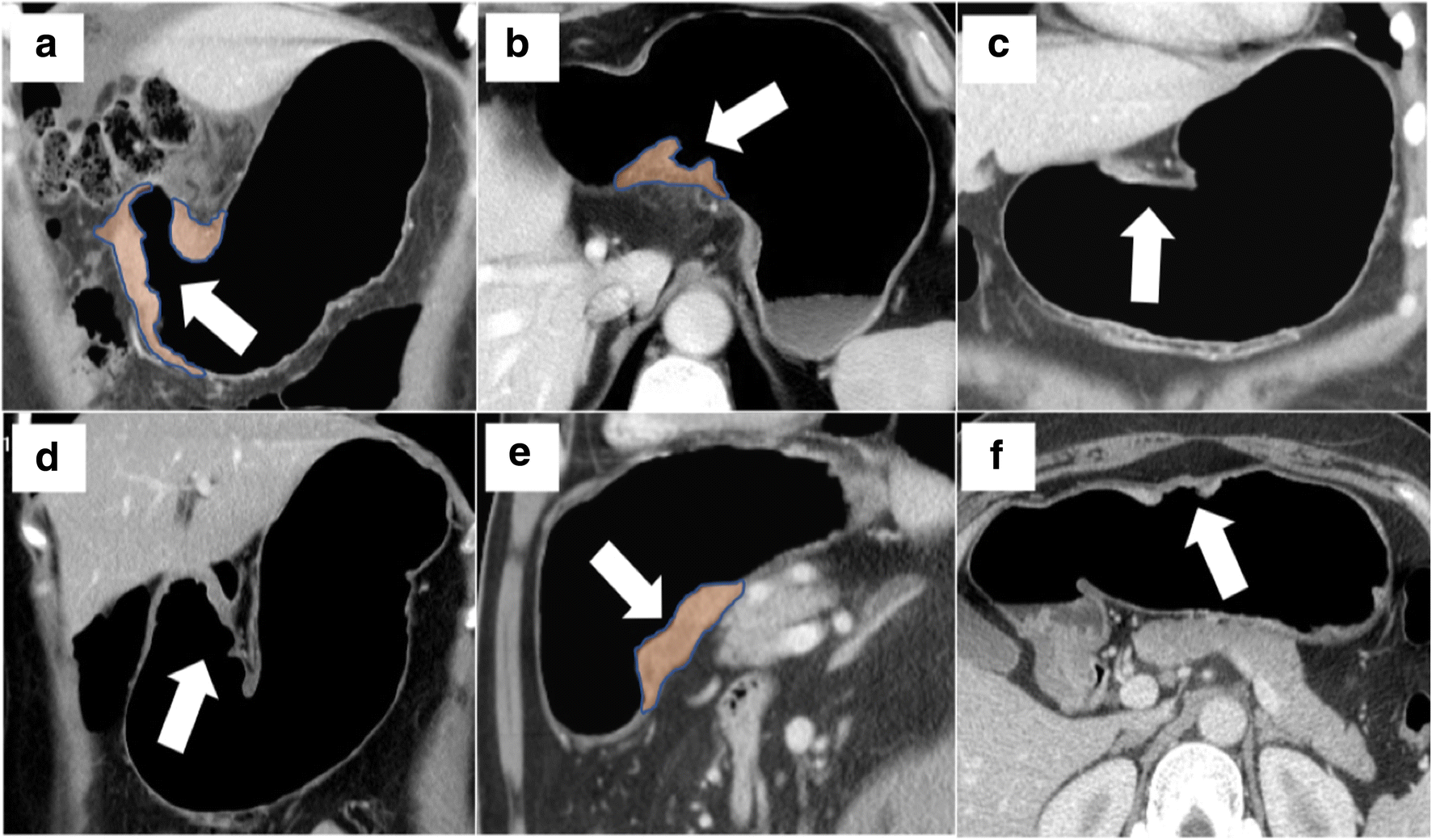 Gastric cancer and imaging biomarkers: Part 1 – a critical review of DW ...