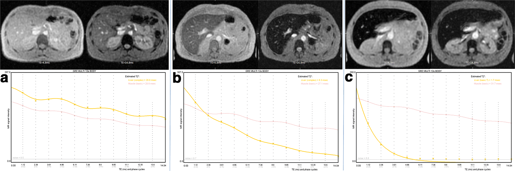 Practical guide to quantification of hepatic iron with MRI | SpringerLink