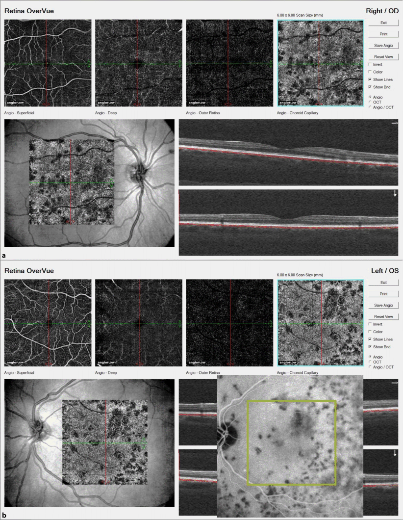 OCT-Angiographie-Befund bei akuter posteriorer multifokaler plakoider ...