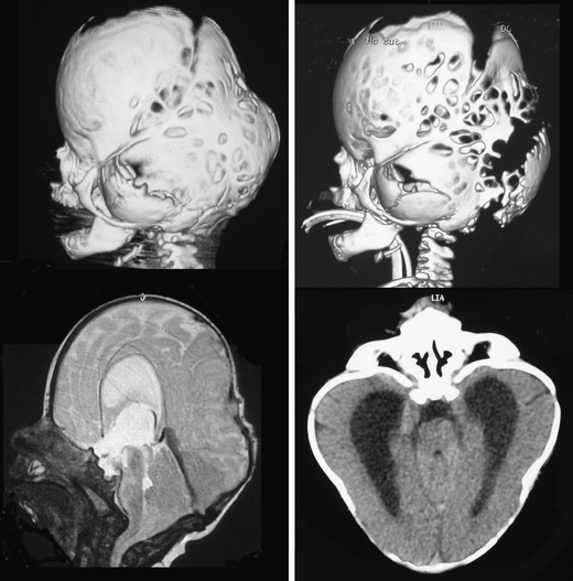Cloverleaf skull deformity and hydrocephalus | SpringerLink