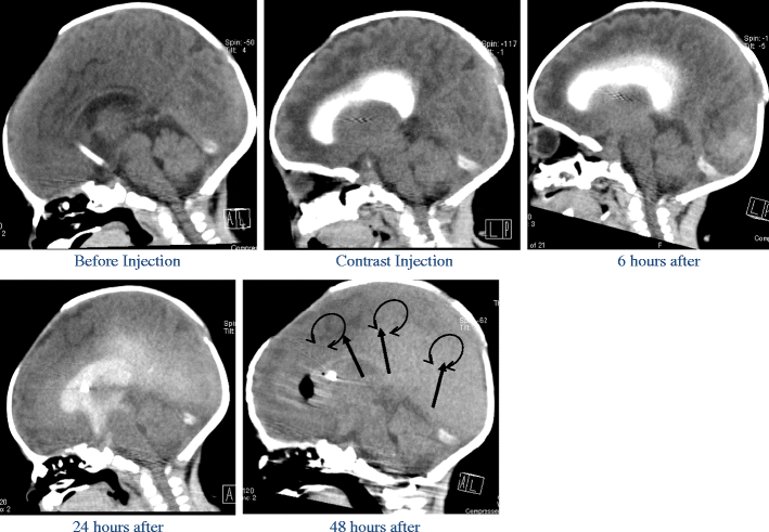 Classification of hydrocephalus: critical analysis of classification ...