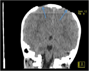 Enlarged parietal foramina: a review of genetics, prognosis, radiology ...