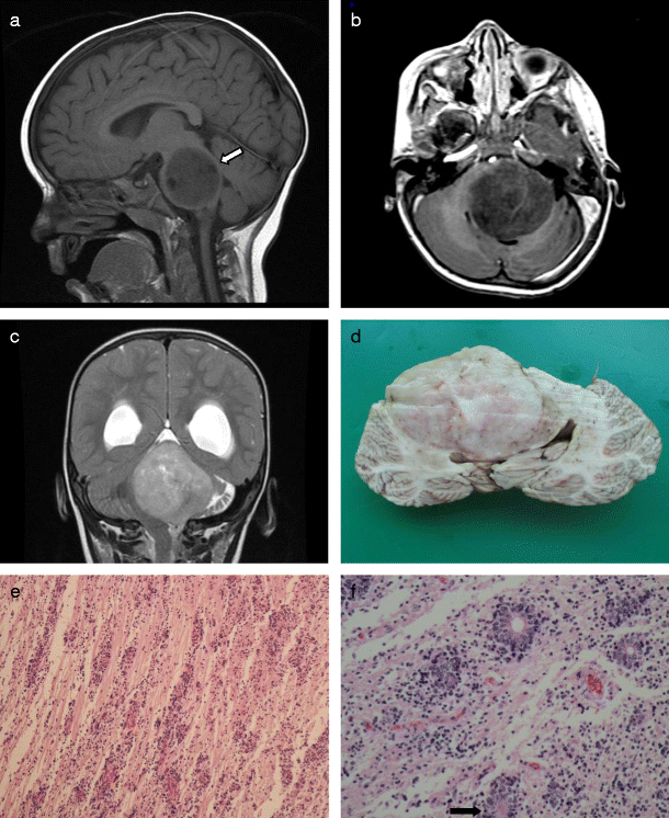 Embryonal tumor with abundant neuropil and true rosettes: an autopsy ...