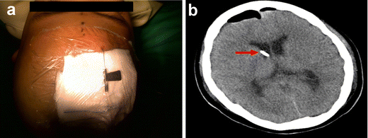External drainage with an Ommaya reservoir for perioperative ...