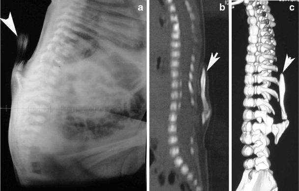 A bony human tail causing tethered cord syndrome: case report ...