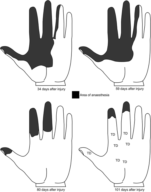 Sir Herbert Seddon (1903–1977) and his classification scheme for ...