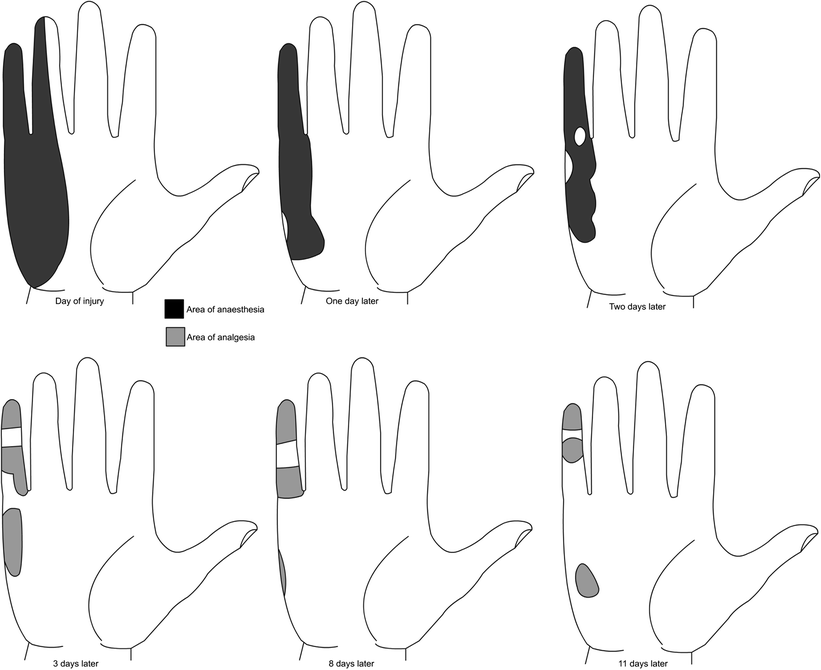 Sir Herbert Seddon (1903–1977) and his classification scheme for ...