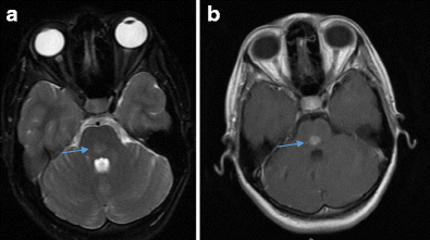 Symptomatic capillary telangiectasia of the pons: three pediatric cases ...
