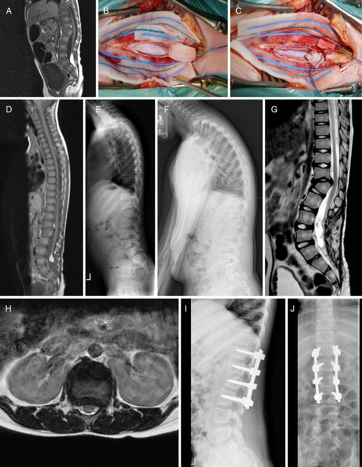 Childhood angular kyphosis: a plea for involvement of the pediatric ...