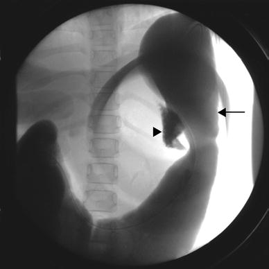 Splenic flexure volvulus in a child with chronic idiopathic intestinal ...