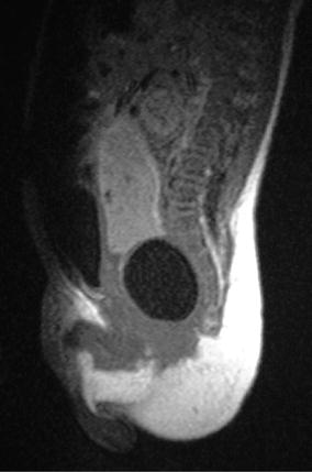 Rectal duplication cyst: a combined abdominal and endoanal operative ...