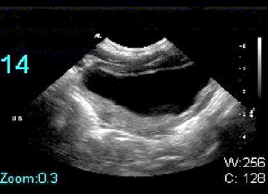 Fibroepithelial polyp of the bladder neck in children | SpringerLink