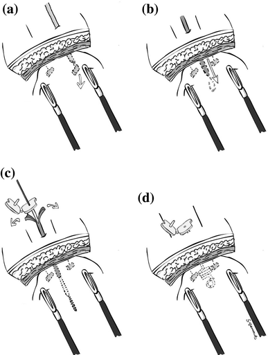 Initial experience with laparoscopic Chait Trapdoor™ cecostomy catheter ...