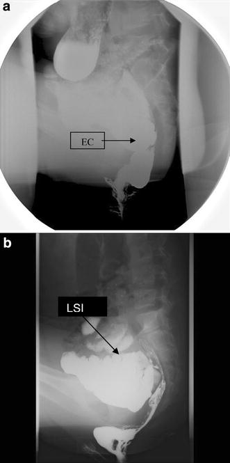 Dynamic defecography in the diagnosis of paediatric rectal prolapse and ...