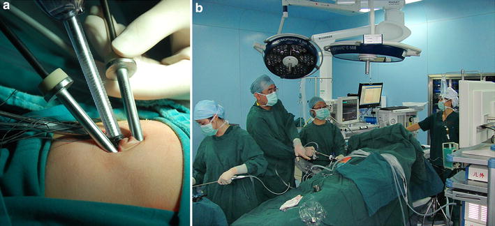 Subtotal colectomy with a single-incision laparoscopic surgery ...