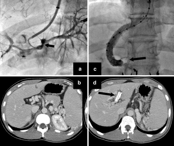 Meso-Rex bypass to manage prehepatic portal hypertension after the ...