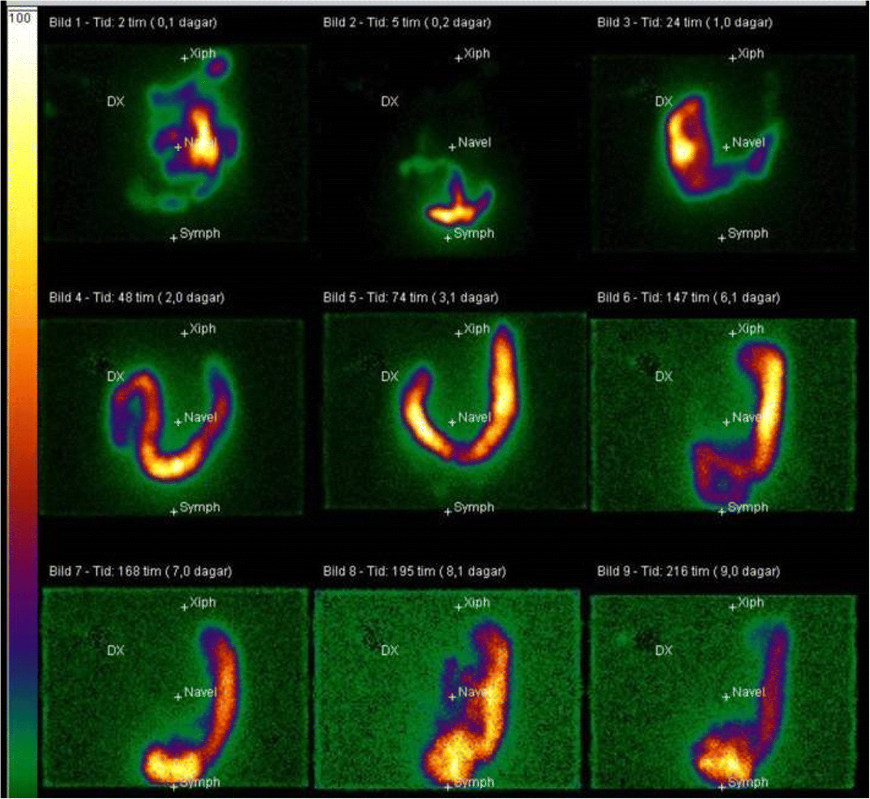 Long-term outcome after segmental colonic resection for slow transit ...