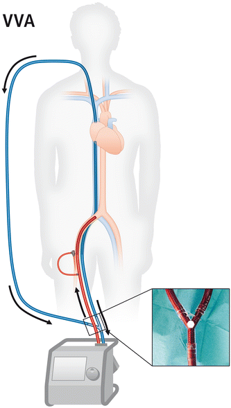 Cannulation strategies for percutaneous extracorporeal membrane ...