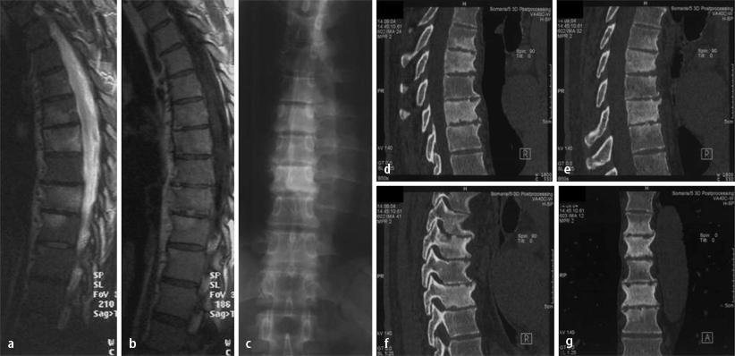 Knochen(mark)ödem in der MRT – Befund oder nur Signal? | SpringerLink