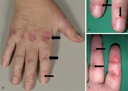 Frühsymptome der Dermatomyositis und des Antisynthetase-Syndroms ...