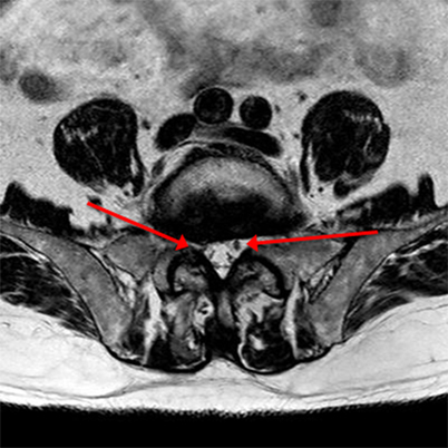 Lumbale Spinalkanalstenose | SpringerLink