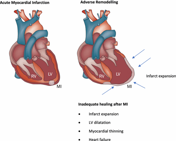 Molecular imaging of cardiac remodelling after myocardial infarction ...