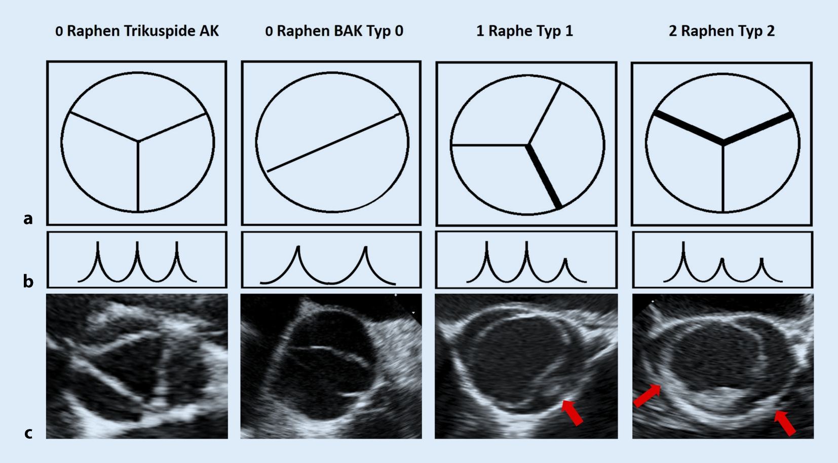 Aortenklappeninsuffizienz | SpringerLink