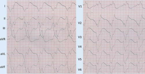 Bundle-Branch-Reentry-VT | SpringerLink