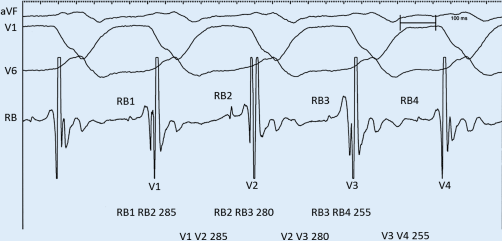 Bundle-Branch-Reentry-VT | SpringerLink