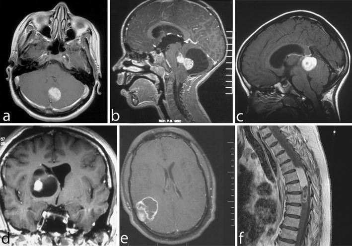 Pilocytic astrocytoma: pathology, molecular mechanisms and markers ...