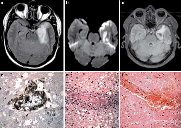 Neurotropic virus infections as the cause of immediate and delayed ...