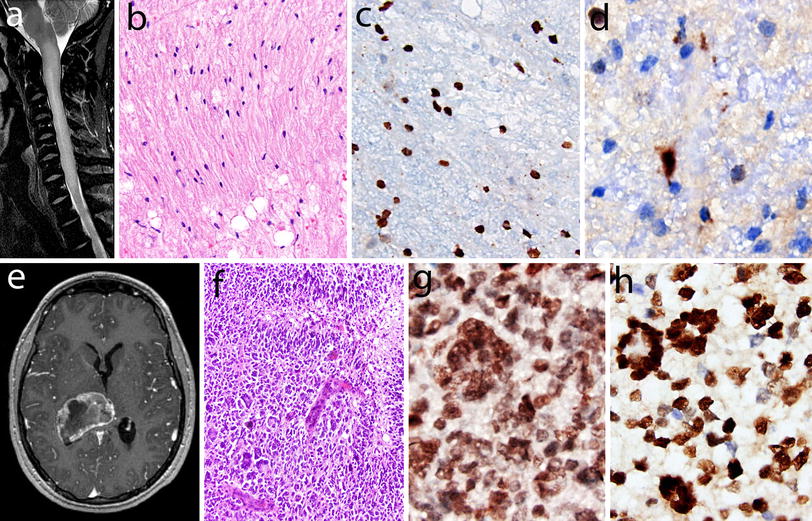 The 2016 World Health Organization Classification of Tumors of the ...