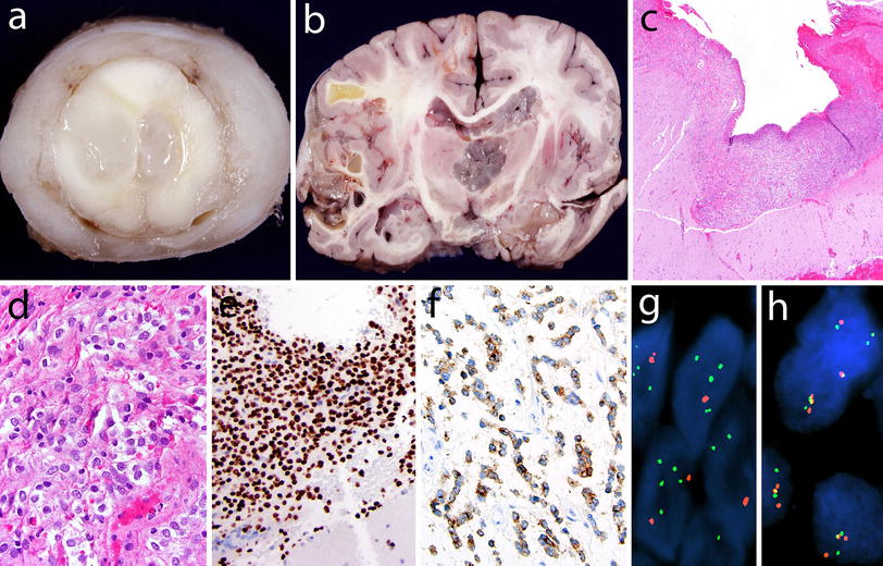 The 2016 World Health Organization Classification of Tumors of the ...