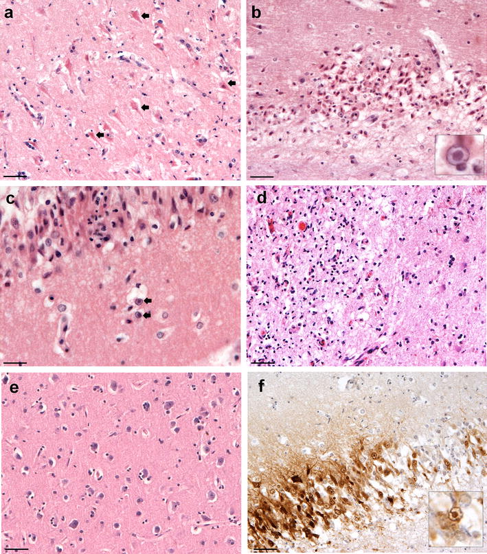 Herpes simplex encephalitis is linked with selective mitochondrial ...