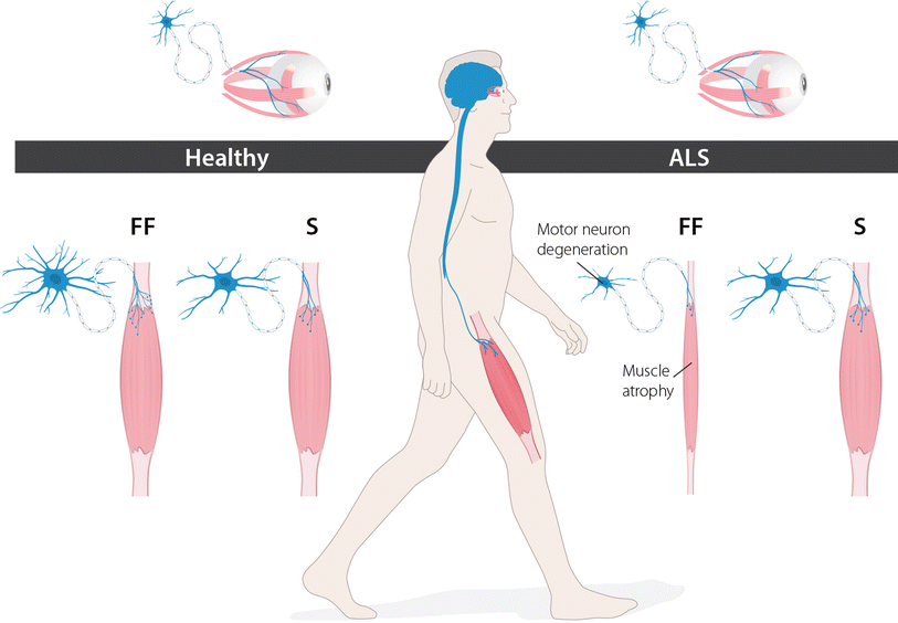 Motor neuron vulnerability and resistance in amyotrophic lateral ...