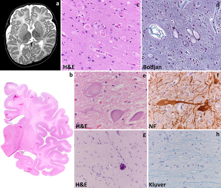 Leukodystrophies: a proposed classification system based on ...
