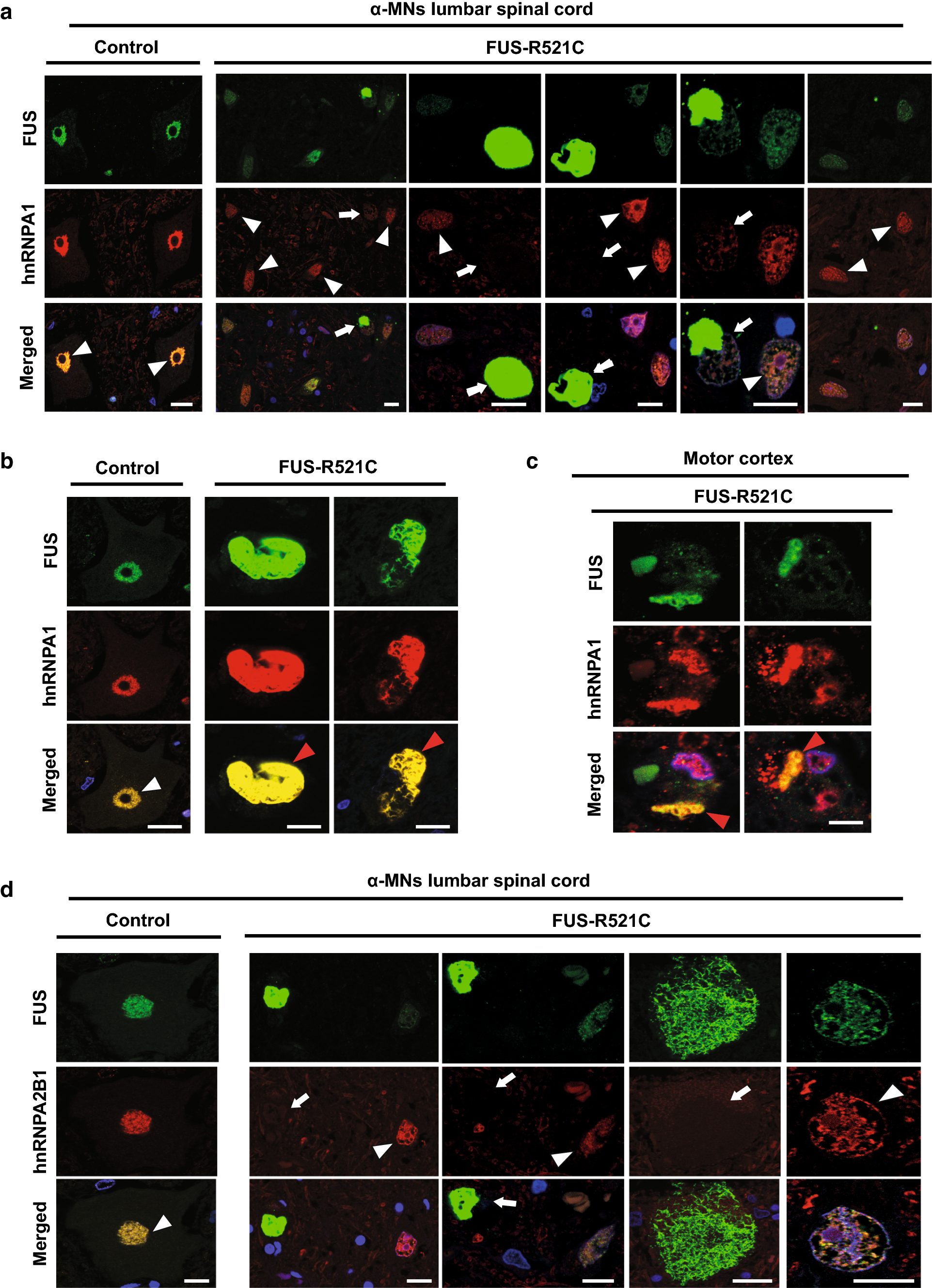 FUS pathology in ALS is linked to alterations in multiple ALS ...