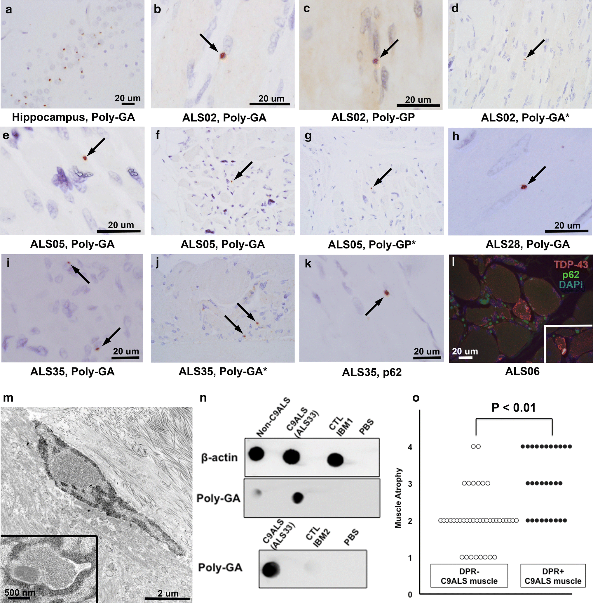 Dipeptide repeat (DPR) pathology in the skeletal muscle of ALS patients ...