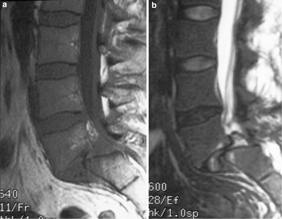 Acute traumatic L5–S1 spondylolisthesis: a case report | SpringerLink